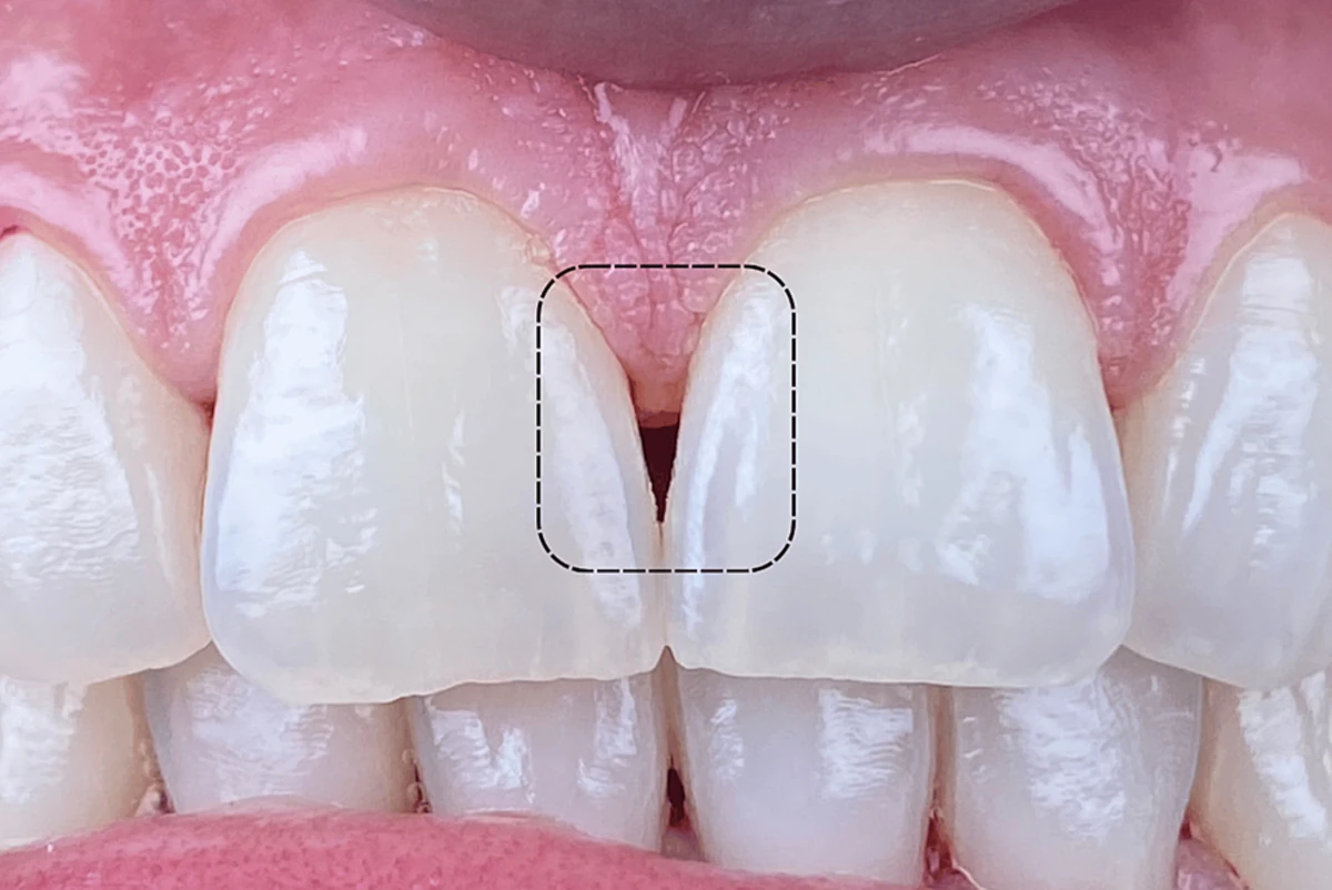 Black Triangles Between Teeth: Causes and Treatment